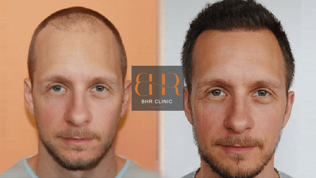 BHR Clinic – Hair Transplant – BHR Clinic