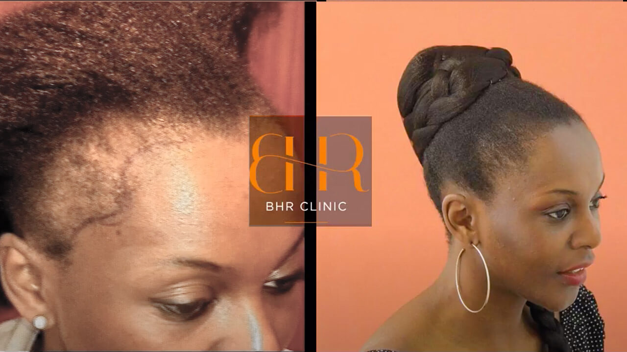 BHR Clinic – Hair Transplant – BHR Clinic