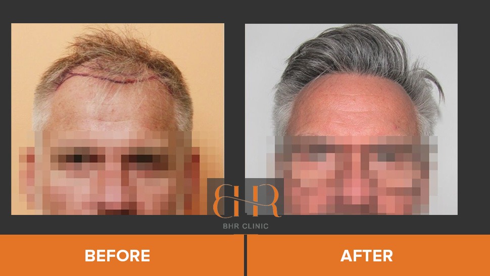 Results - BHR Clinic - Hair Transplant Surgery