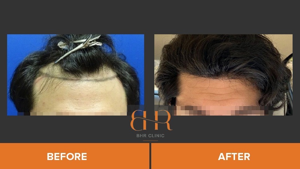 Results - BHR Clinic - Hair Transplant Surgery