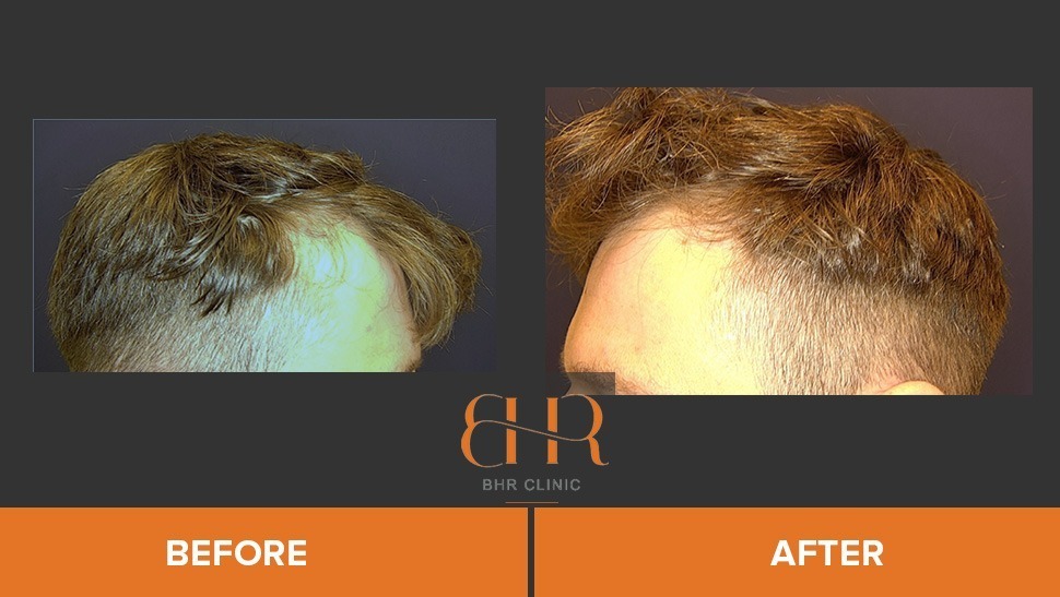 Results - BHR Clinic - Hair Transplant Surgery