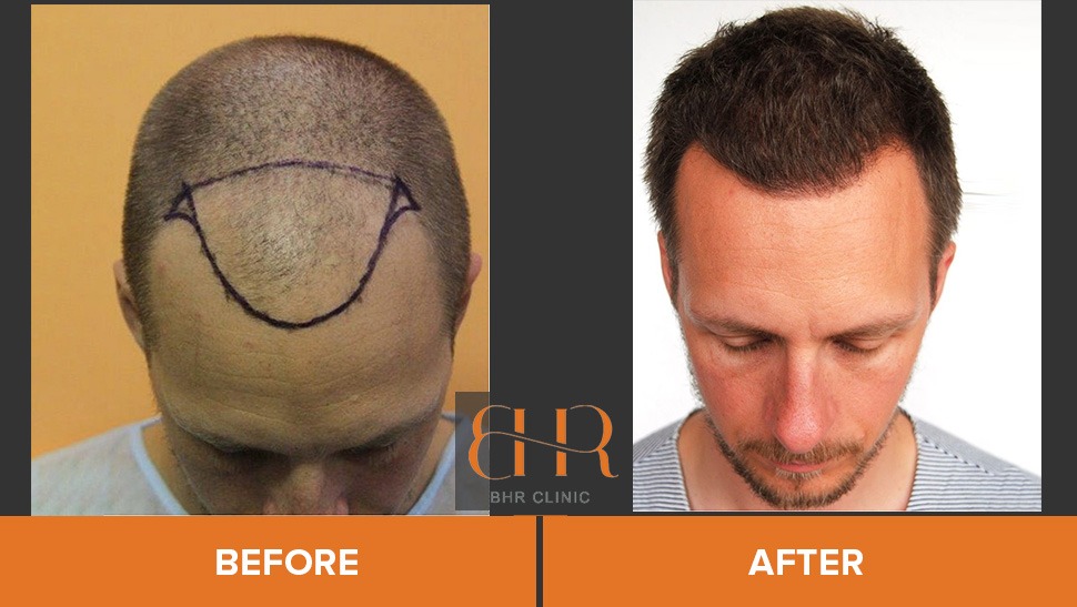 Results - BHR Clinic - Hair Transplant Surgery