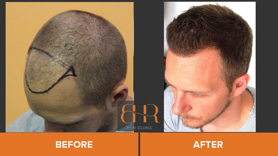 Results - BHR Clinic - Hair Transplant Surgery