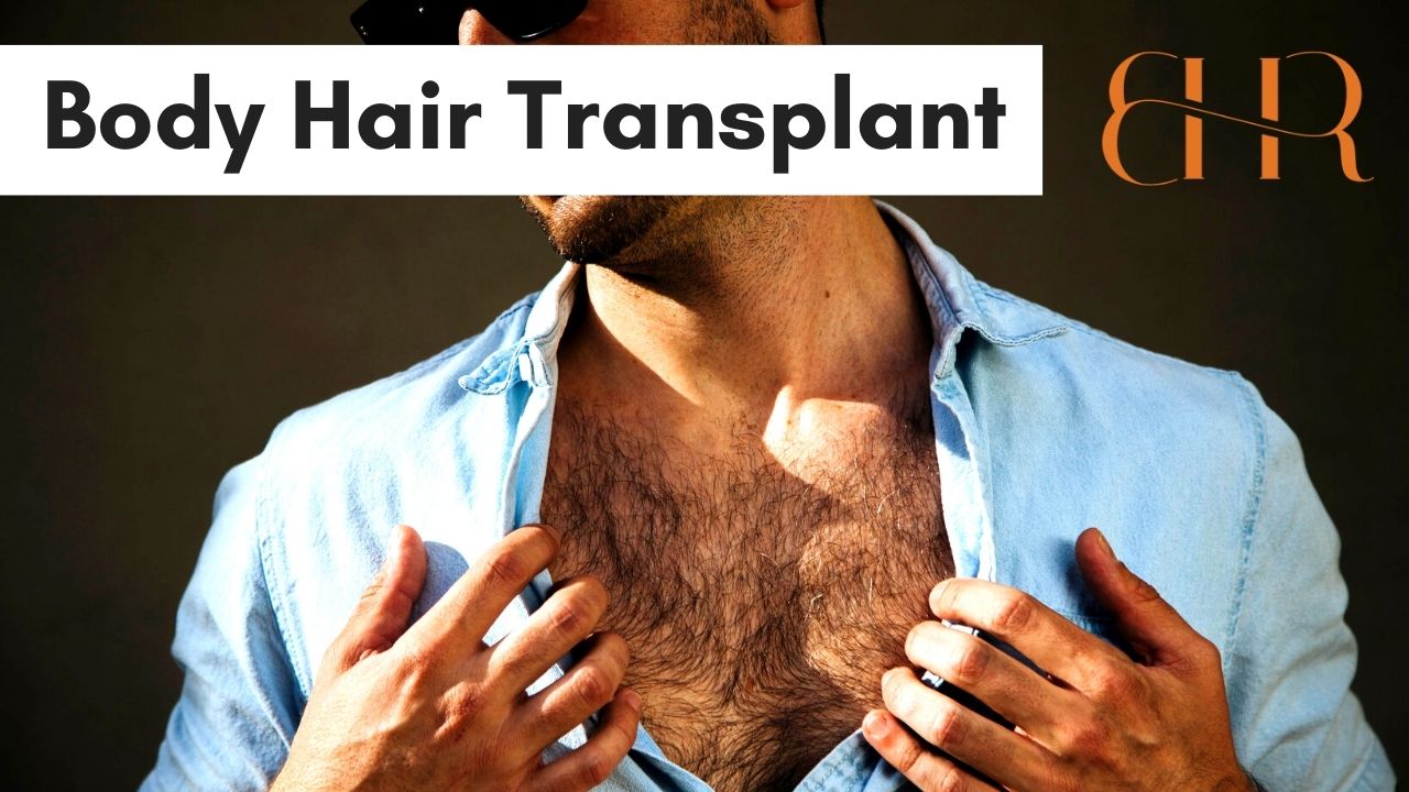 Body Hair Transplant Using Chest Hair For Fue Surgery Bisanga Hair